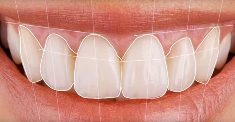 DSD - Digital Smile Design - O planejamento digital do sorriso